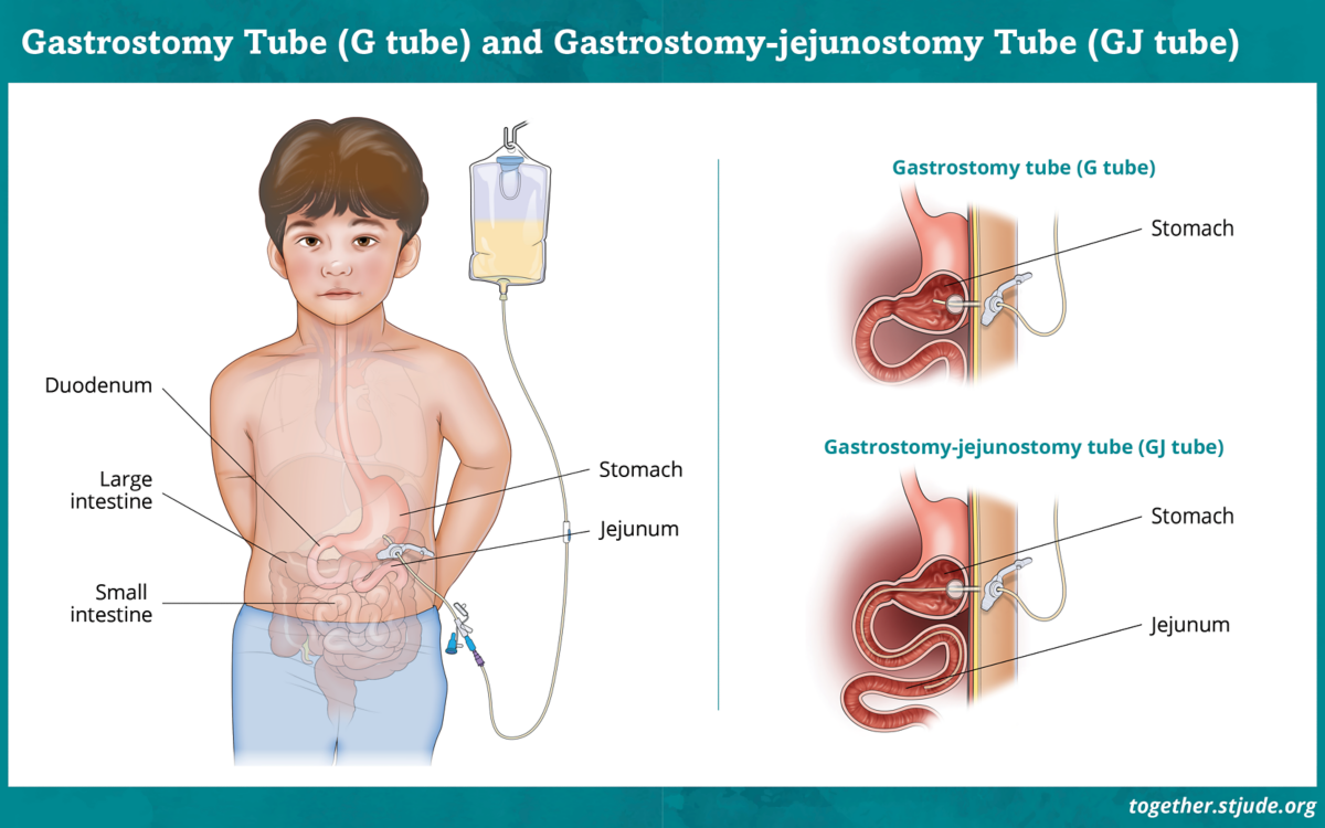 Types Of Feeding Tubes And Devices Together By St Jude邃